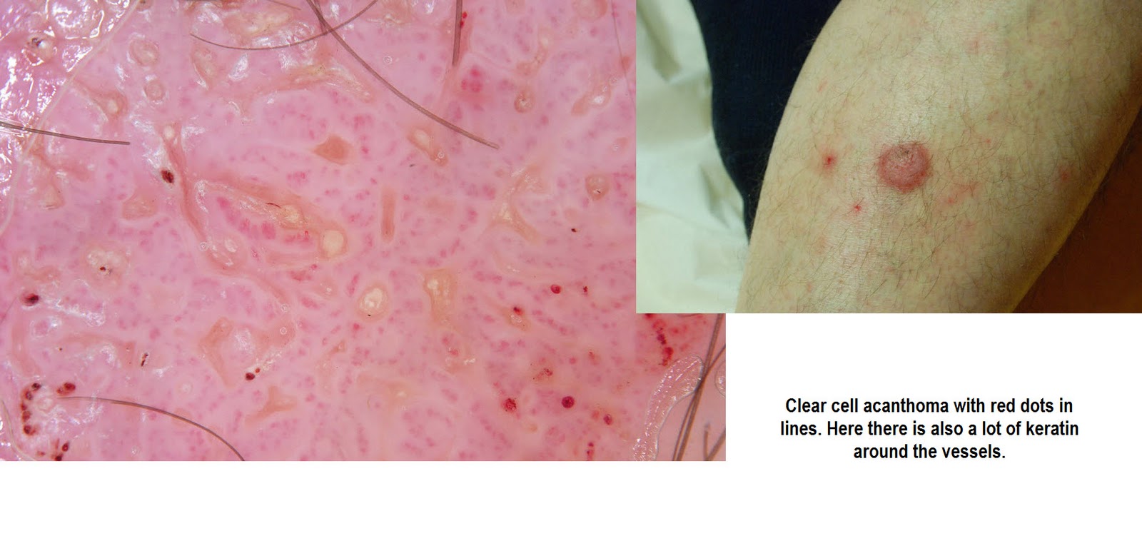 Dermoscopy Made Simple: Clear Cell Acanthoma