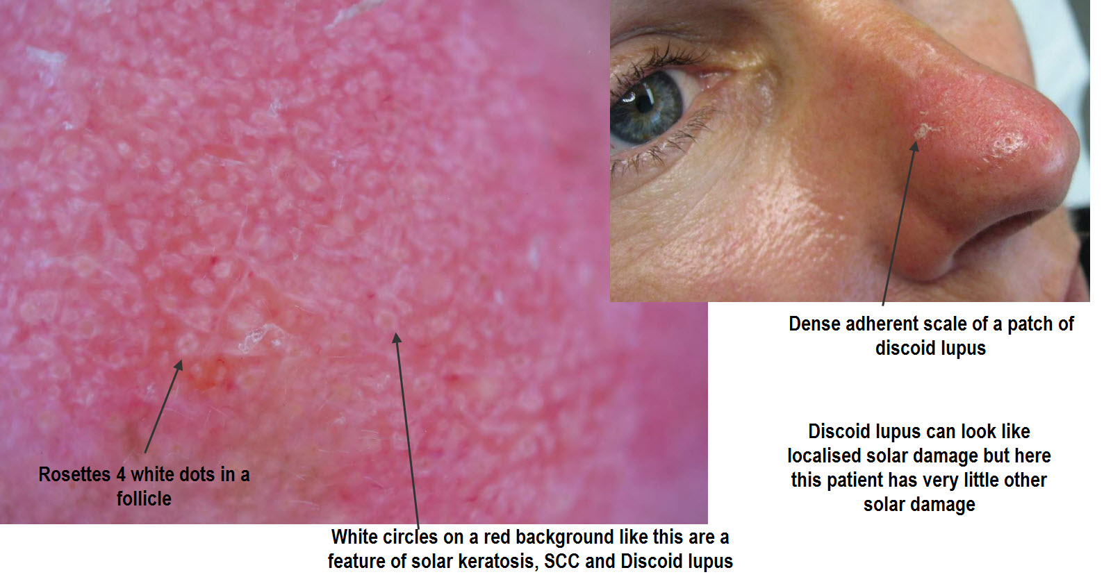 Dermoscopy Made Simple: Other Medical Conditions