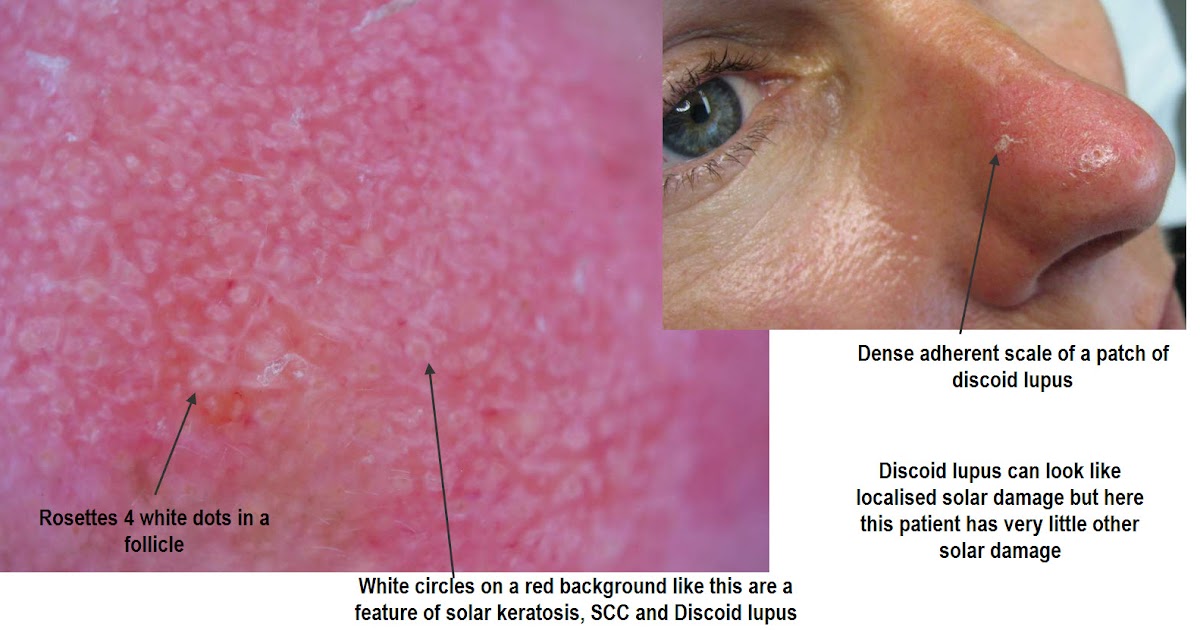 Dermoscopy Made Simple: Other Medical Conditions