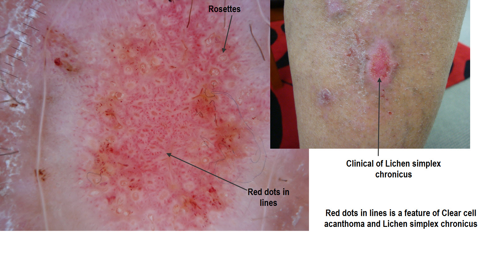Dermoscopy Made Simple: Vessels