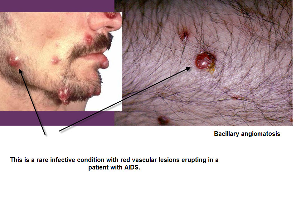 Dermoscopy Made Simple: Haemangioma and Angiokeratoma
