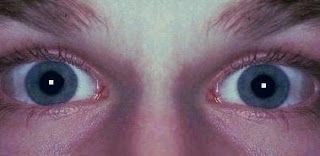 Ocular Physiology: Marcus Gunn Pupil