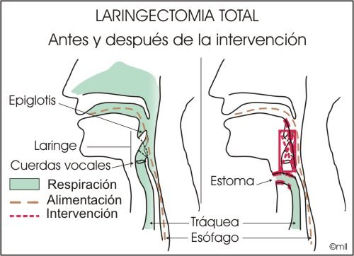 Fonoaudiologia & Nutrição: Laringectomia