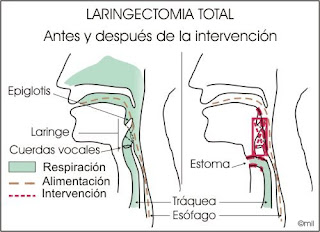 Fonoaudiologia & Nutrição: Laringectomia