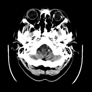 RiT radiology: What is this ocular prosthesis called?