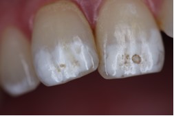 OdontoBlogger: Fluorose Dentária