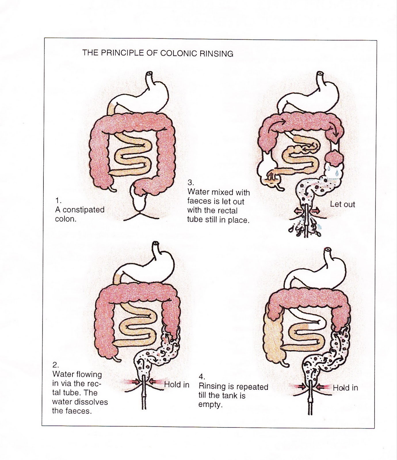 West Sussex Colonics: Diagrams - problems that can arise in the colon