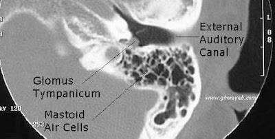 myMRI-CTblog: Glomus Typanicum Tumor