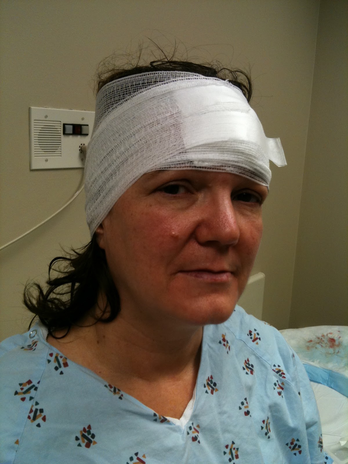 Exuberating Fantasticisms: Another Head Injury