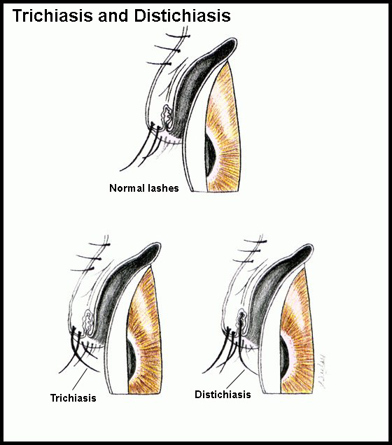 ÚLCERA CORNEAL (Diagnóstico (Úlcera complicada (Citología, Antibiograma,…