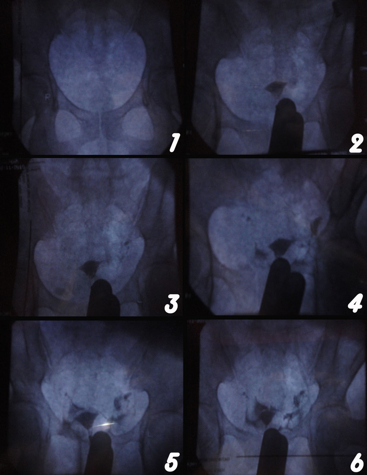 CERITA KITA 2 ORANG: HysteroSalphingoGram (HSG X-RAY)