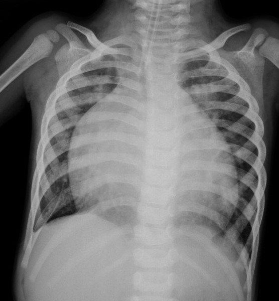 CVT Medical Students: chest films, read by a surgeon