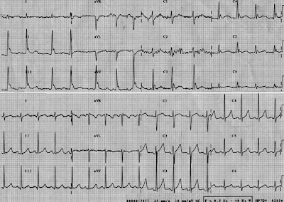 M.D.O.D.: EKG Changes With Hypothermia