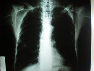 Rayos-5 ;p: Torax Proyeccion PA (los angulos costo - diafragmatico ...