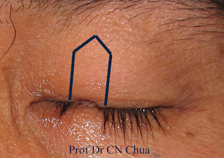 Eyelid Surgery by Prof Dr CN CHUA 蔡鐘能: How I Managed the Lost Eyelashes