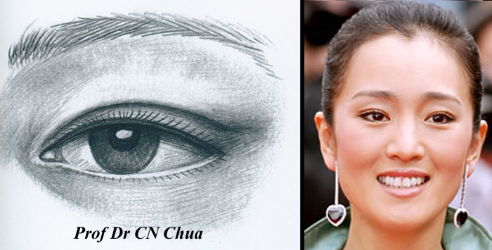 Eyelid Surgery by Prof Dr CN CHUA 蔡鐘能: What Type of Double Eyelid Do ...