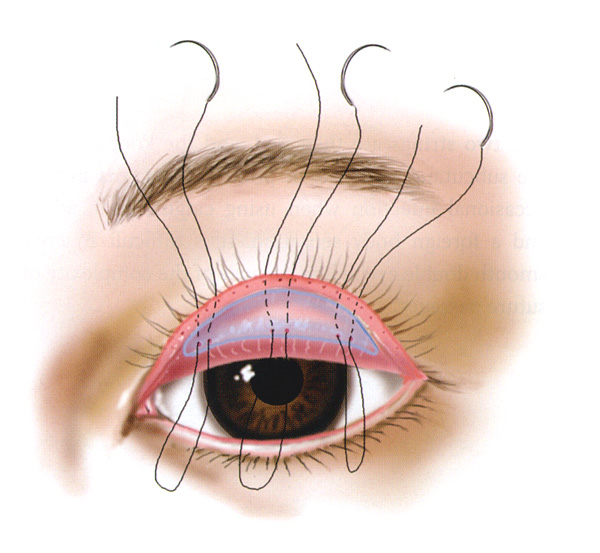 Eyelid Surgery by Prof Dr CN CHUA 蔡鐘能: Different Suture Techniques for ...