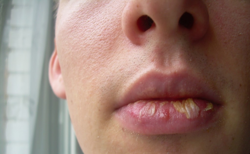 Exfoliative Cheilitis Blog: Exfoliative Cheilitis Biopsy Result