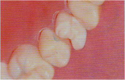 PROSTODONCIA FIJA: Retenedores intracoronales tipo Inlay - Onlay