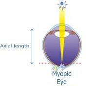 Exploring the world of vision: Refractive disorders: Myopia or ...