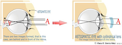 Exploring the world of vision: Refractive disorders: Astigmatism.(5 ...