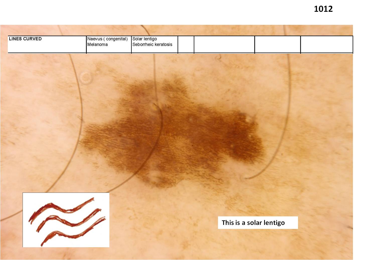 Introduction to Dermatoscopy