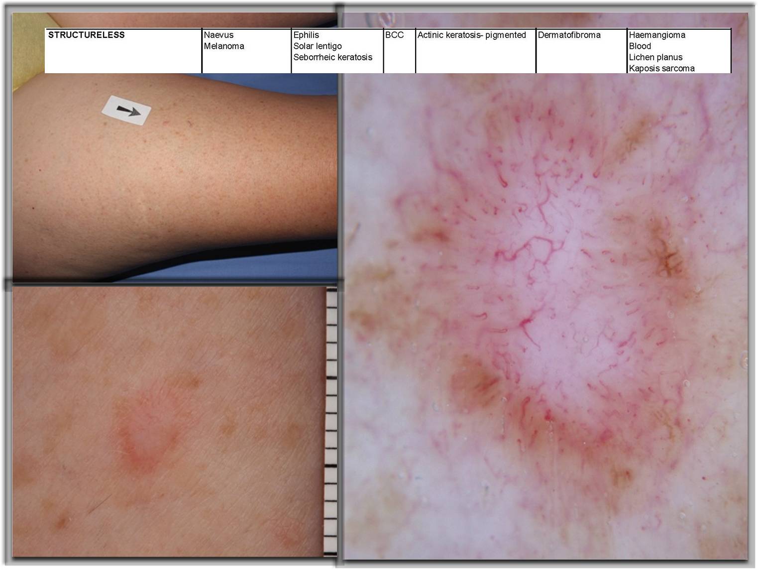 Introduction to Dermatoscopy