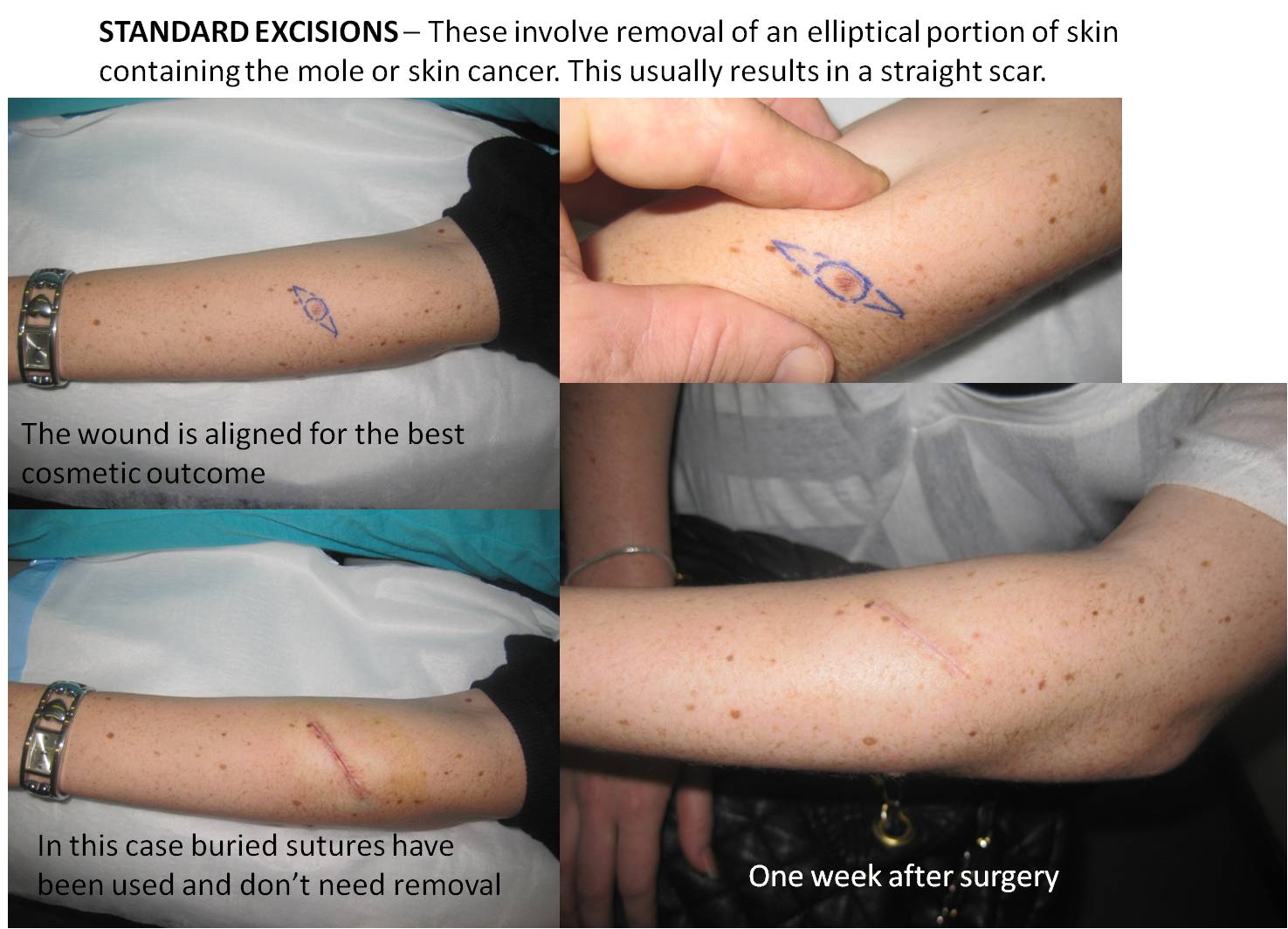 Patient Information about Skin Surgery