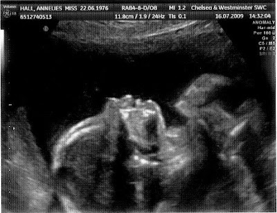 Kaio and Josefine: 5 month scan