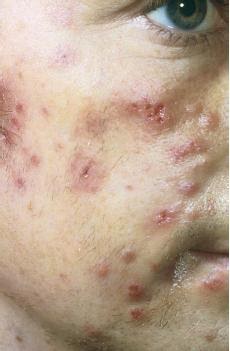 Leukemia Rash Face Rashes With Acute Myeloid Leukemia | MyLeukemiaTeam