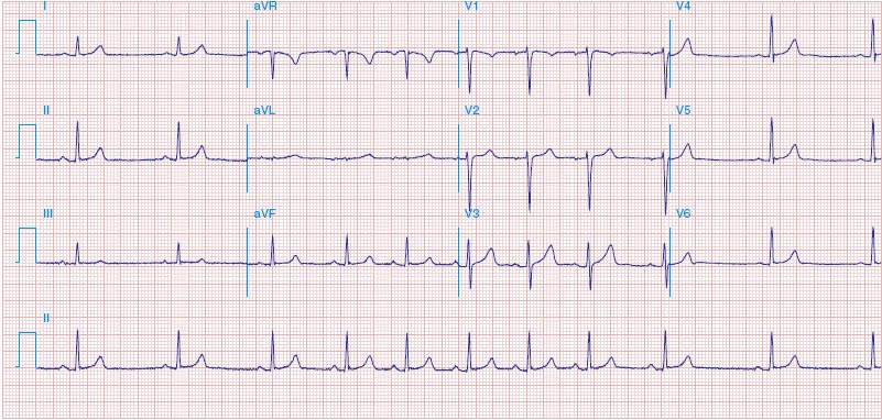 Blog do ECG: ARRITMIA SINUSAL RESPIRATÓRIA