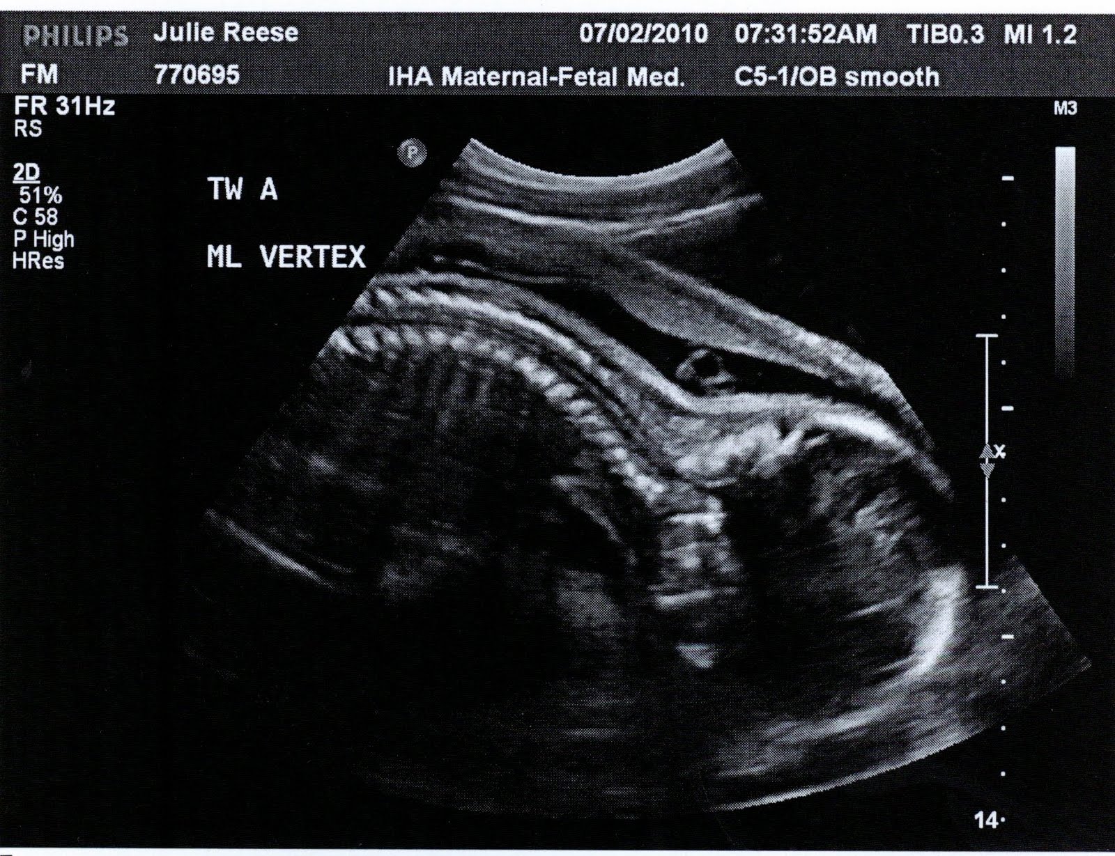 Reese Adventures: Week 26 Ultrasounds
