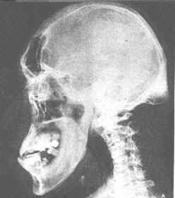 Brooke's RADT 413 Blog: Acromegaly