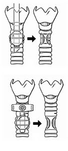 Post-Intubation Tracheal Stenosis | Paramedicine 101