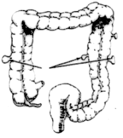 IRIDOLOGY: ANW and Pocket Bowel in Colon