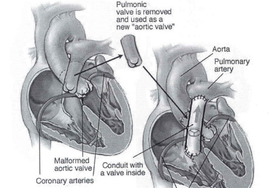 The Heart Of A Boy...: What is the Ross Konno Operation?