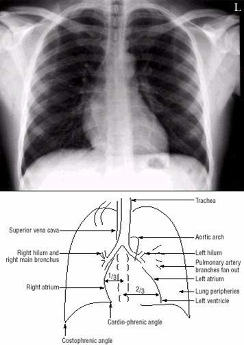 Critical Care Medicine: Normal Chest Xray