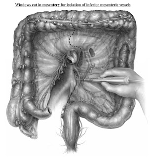 surgical operations: Open Anterior resection