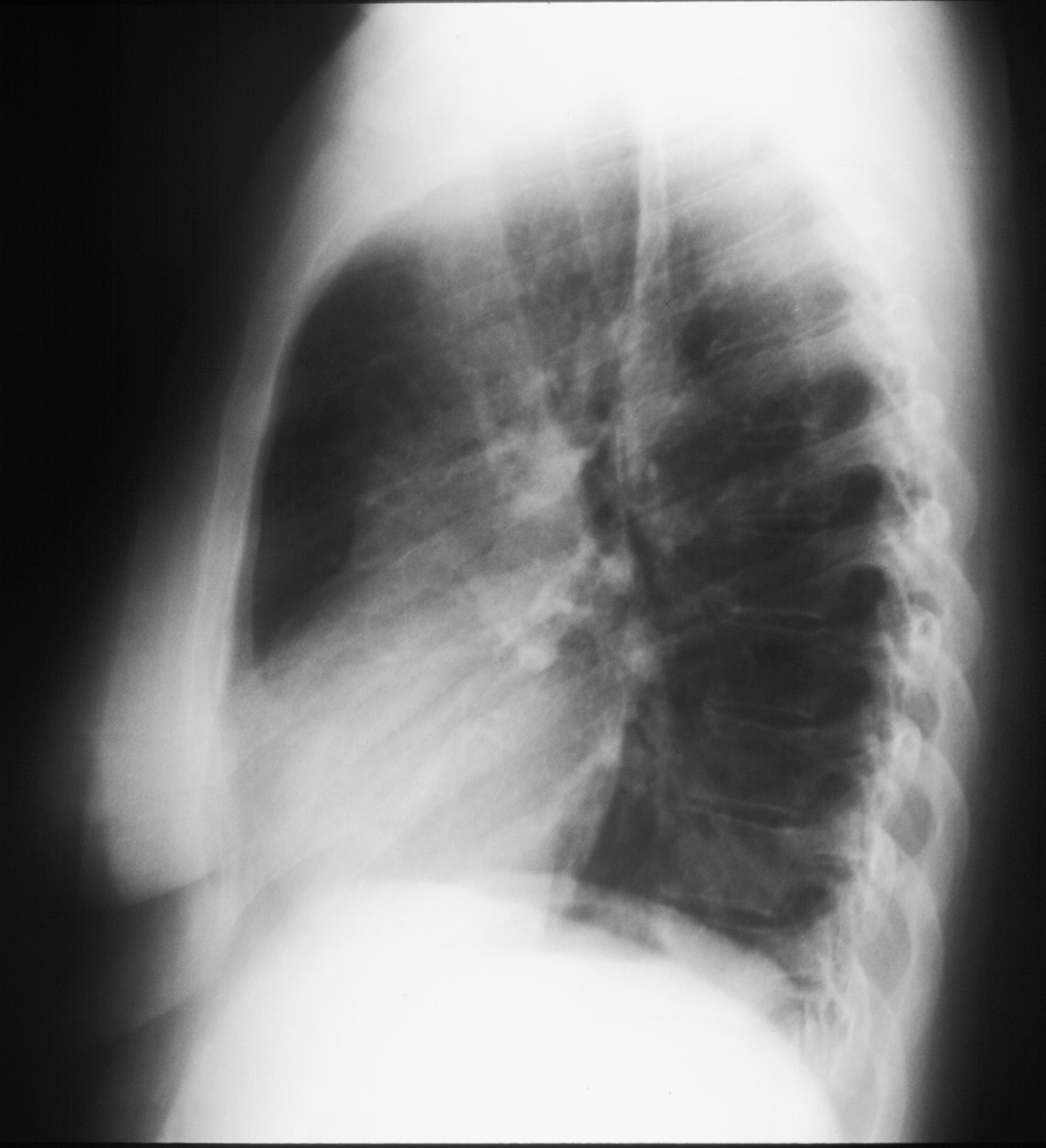 Radi0l0gia: Lateral de Torax