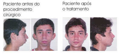 clinica carlos dantas: Publicação na Revista Dental Press - Tratamento ...