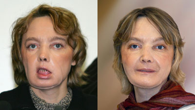 Efomania: First Full-Face Transplant Is A Success