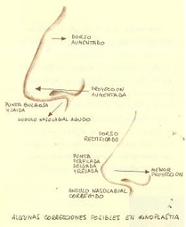 El aire por la nariz: La rinoplastia