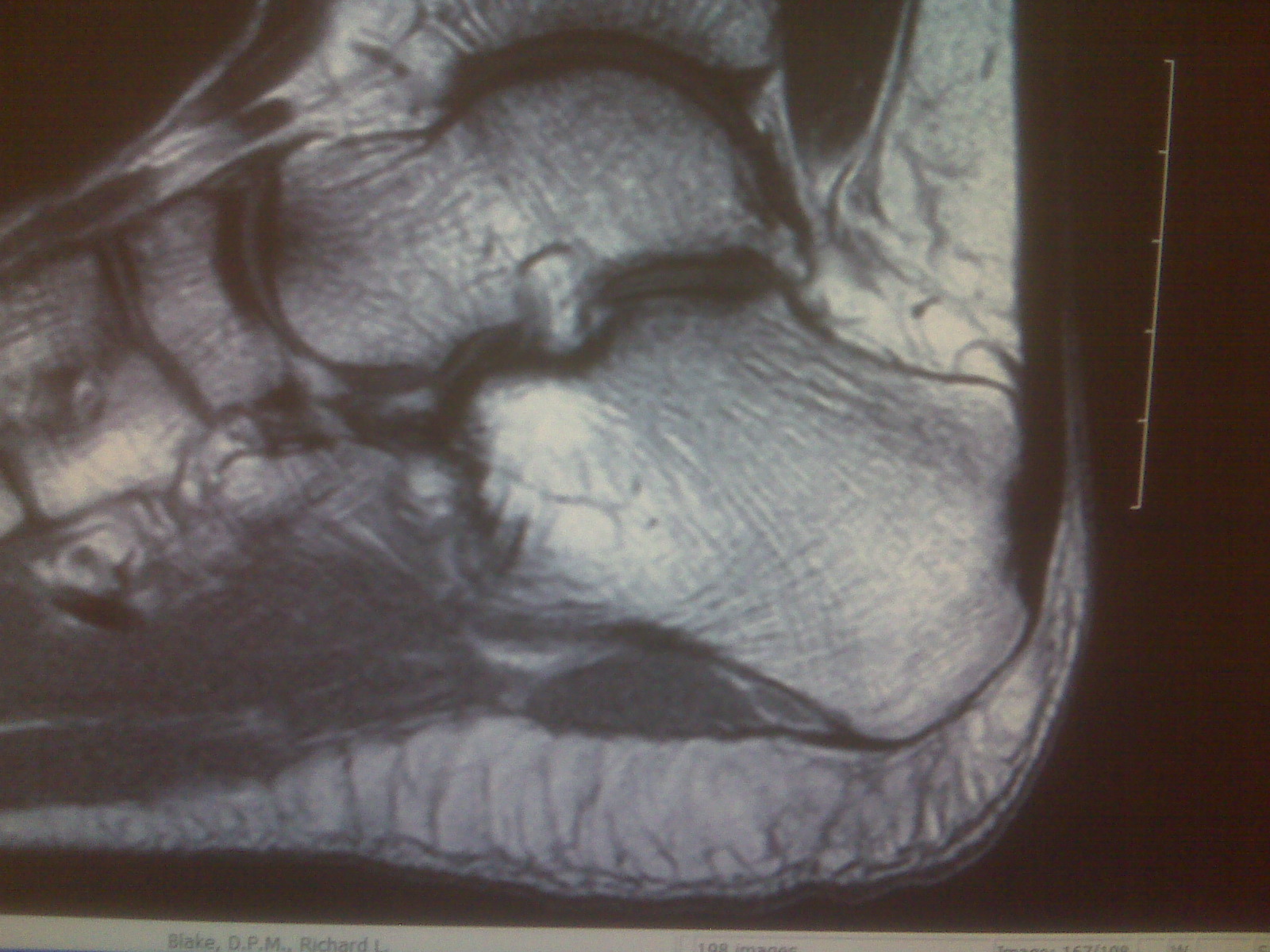 Foot and Ankle Problems By Dr. Richard Blake: Plantar Fascial Tear ...