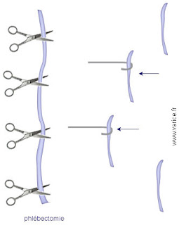 Traitement des varices aux jambes: Opération des veines saphènes