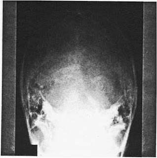 Twis's Blog: Teknik Radiografi Skull (Proyeksi AP Axial Towne Method)