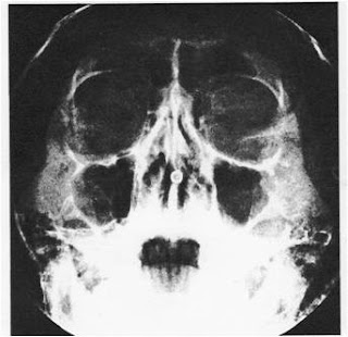 AKHSANUR BLOG'S: Teknik Radiografi Skull (Parietoacanthio : Waters Method)