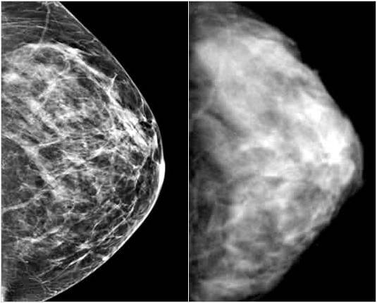 TEKNIK PEMERIKSAAN MAMMOGRAFI | RADIOLOGY LAND