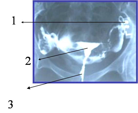 TUKANG RONTGEN BLOG'S: Teknik Radiografi Histerosalpingografi (HSG)