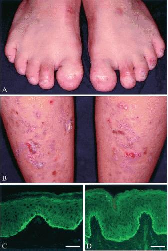 Kaitlynn's Place: Epidermolysis bullosa (EB)