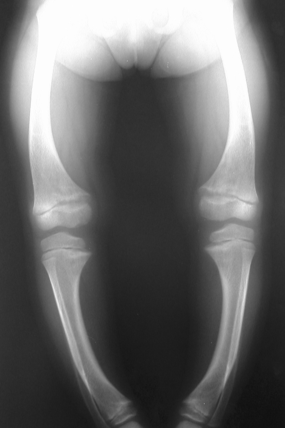 Dr. Amir's Blog: Rickets